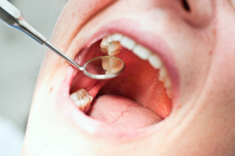 Calculus Bridge: What It Is, How to Prevent It and More