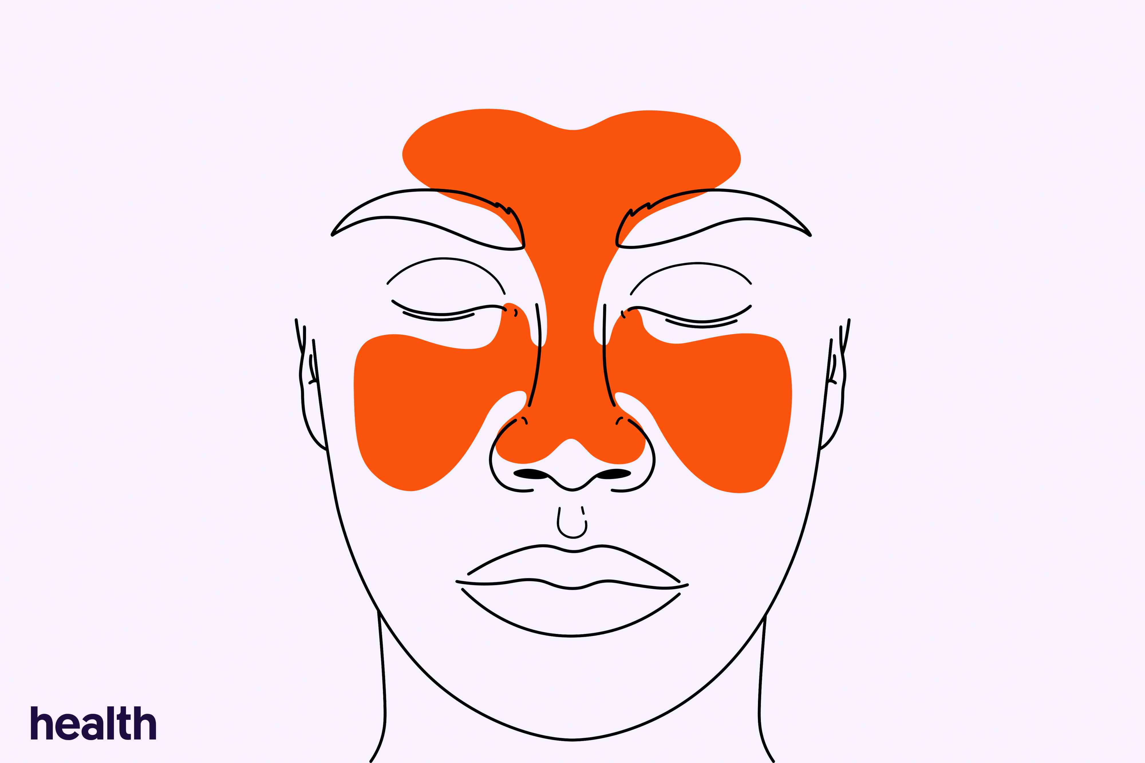 Signs and Symptoms of a Sinus Infection (Sinusitis)