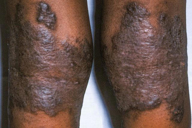 Dermatitis Types and Treatment Options