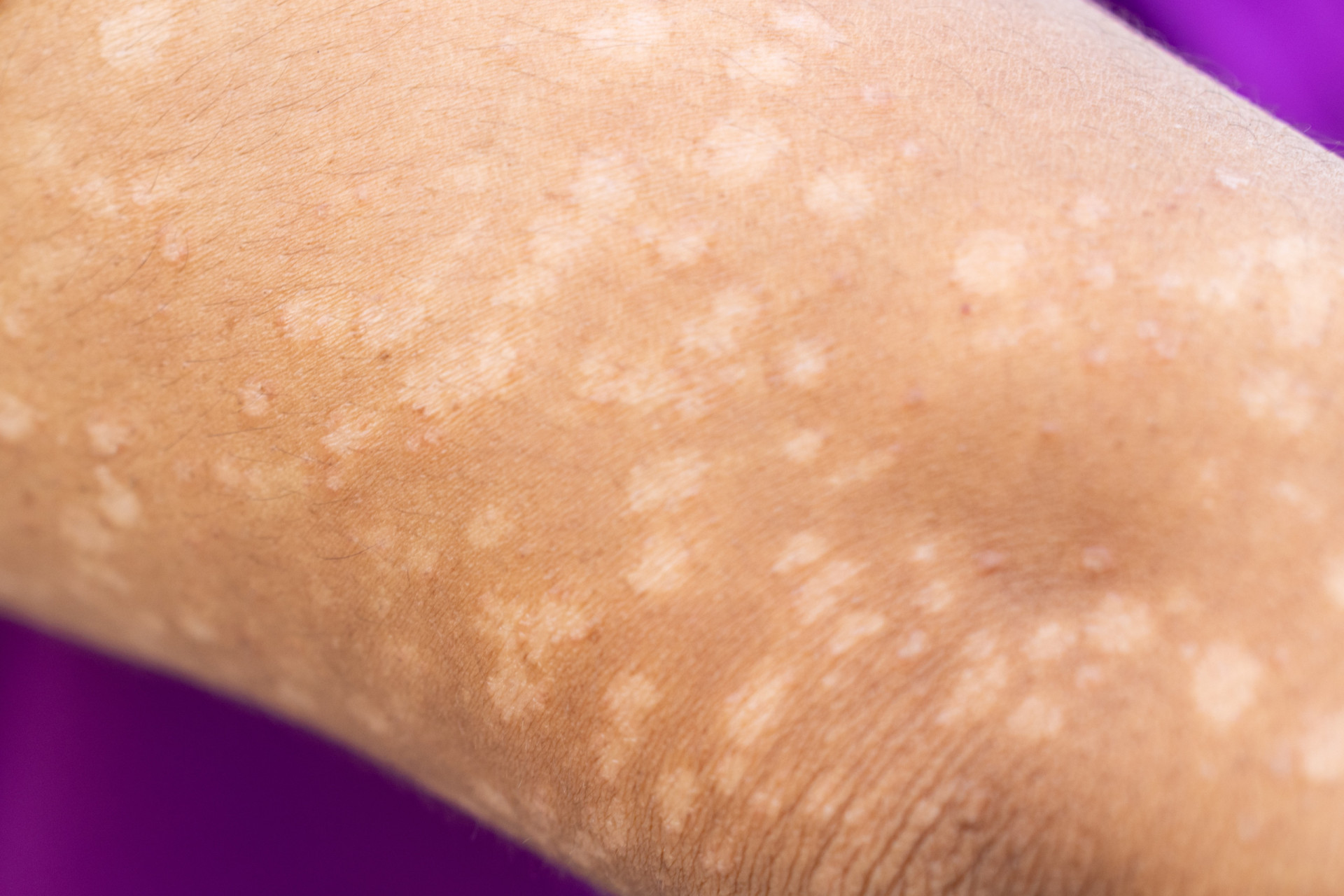 Autoimmune diseases: The facts behind the different types of immune ...