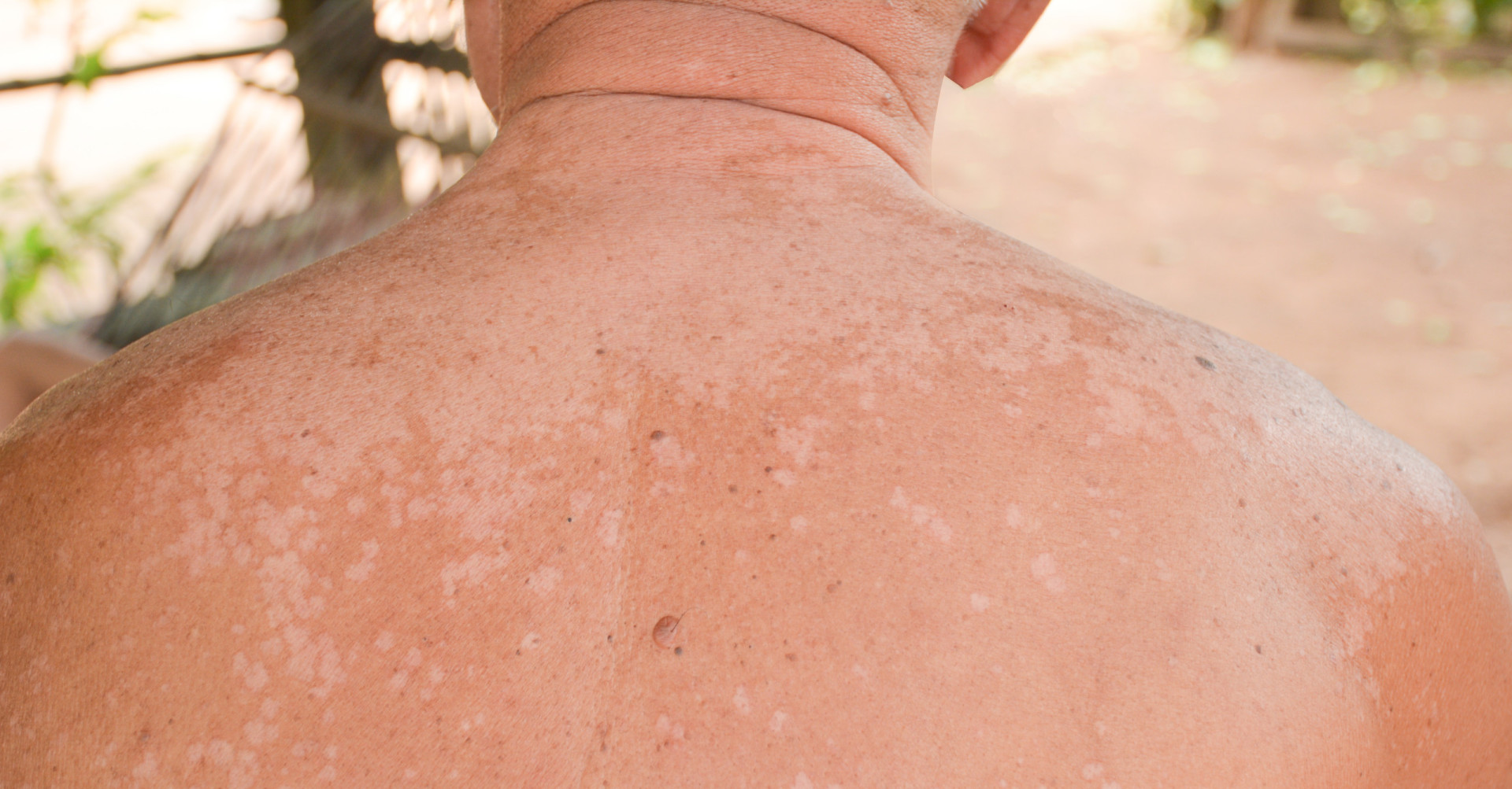 Pityriasis versicolor : tout savoir sur cette mycose cutanée