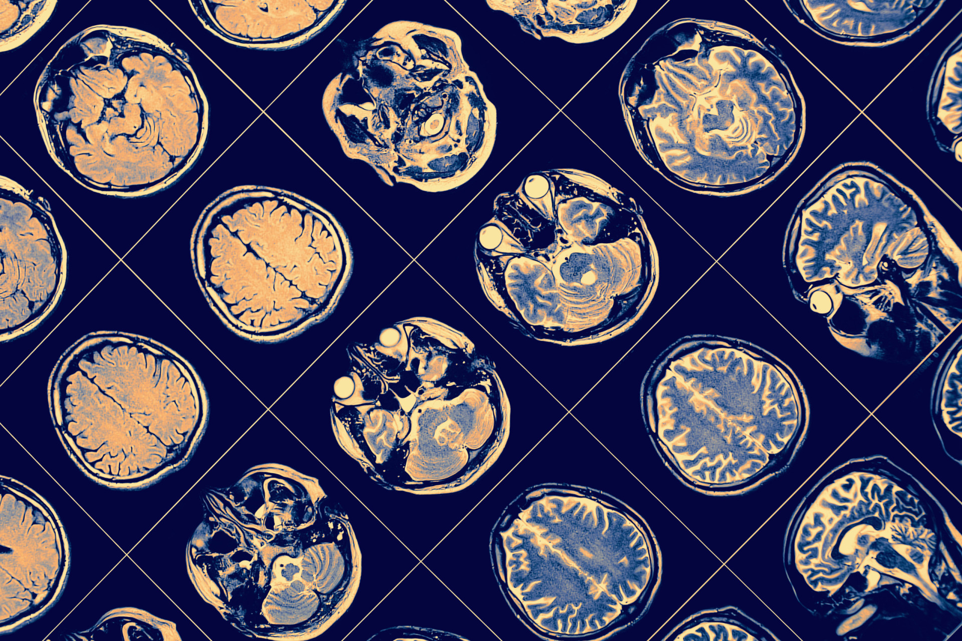 How to identify the warning signs of a stroke