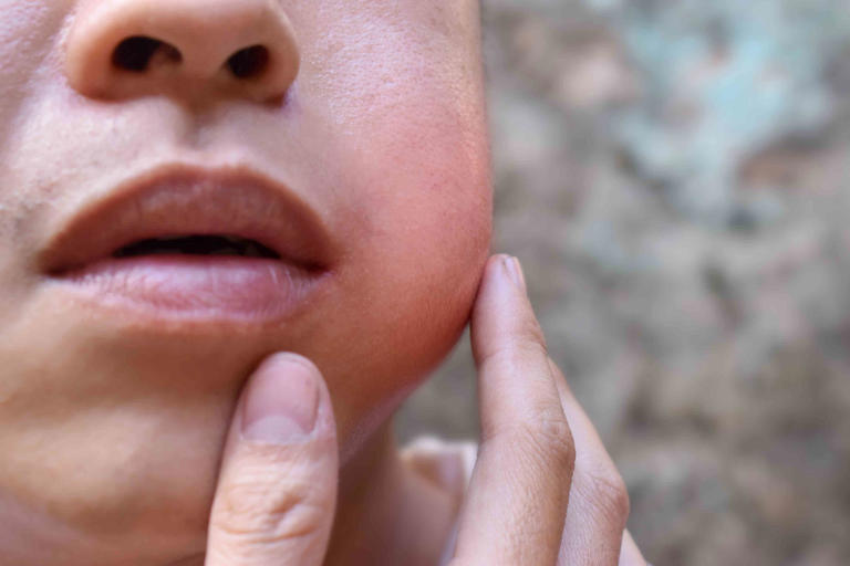 Everything To Know About Mumps
