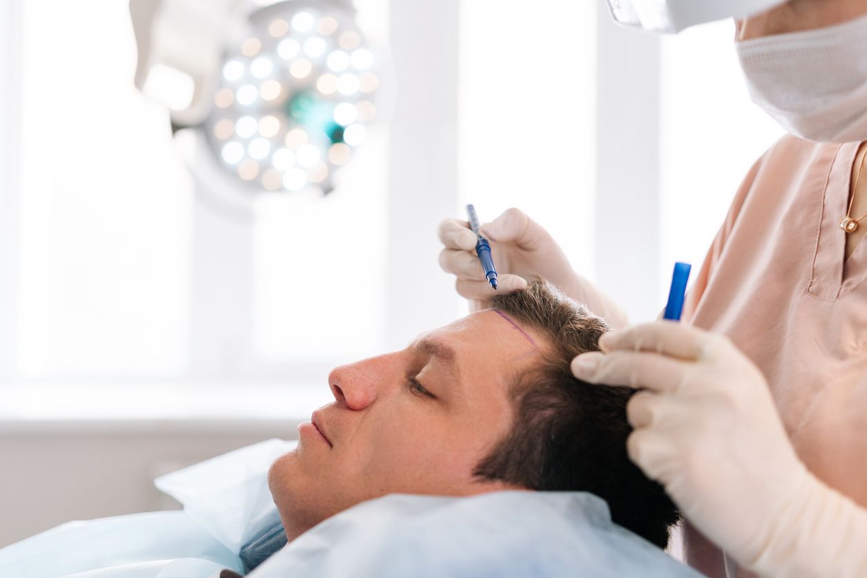 Hair Transplant Recovery Timeline: How Long Will It Take to See Results?