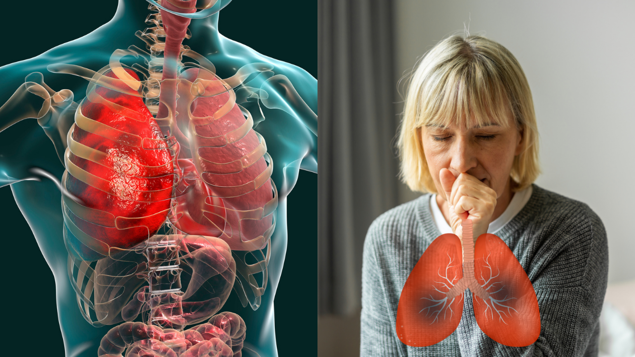 Bronchitis vs. Pneumonia: Expert Tips to Spot the Differences and Seek ...