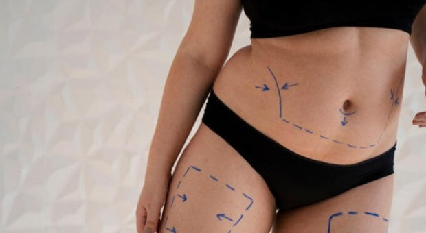 Lipedema: una malattia genetica e degenerativa che colpisce le donne ... Lipedema: una malattia genetica e degenerativa che colpisce le donne ...