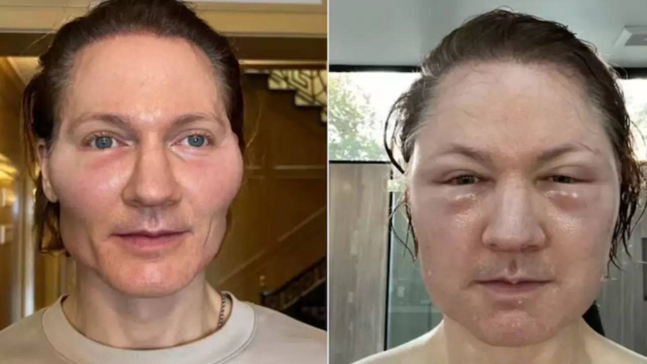 Bloated, Red Face: How An Anti-Ageing Procedure Made Tech Mogul Bryan ... Bloated, Red Face: How An Anti-Ageing Procedure Made Tech Mogul Bryan ...