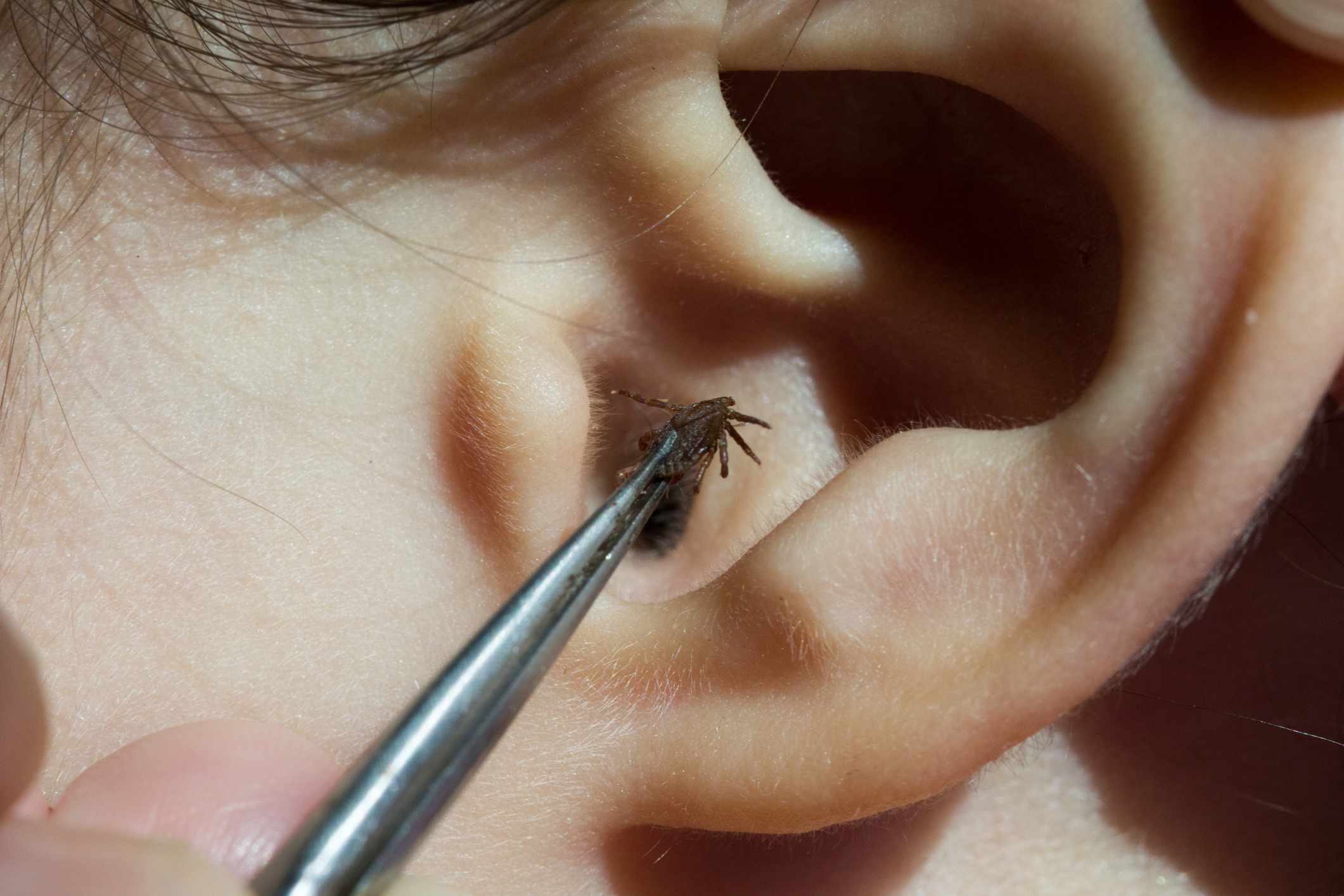 How to Remove a Bug in Your Ear