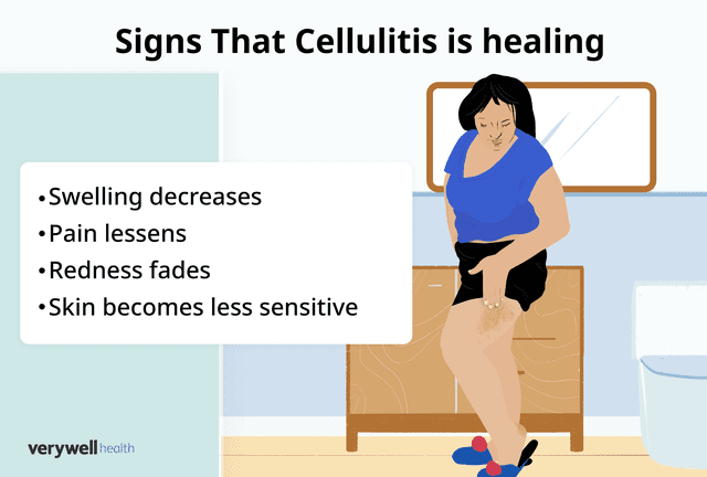 Signs That Cellulitis Is Healing
