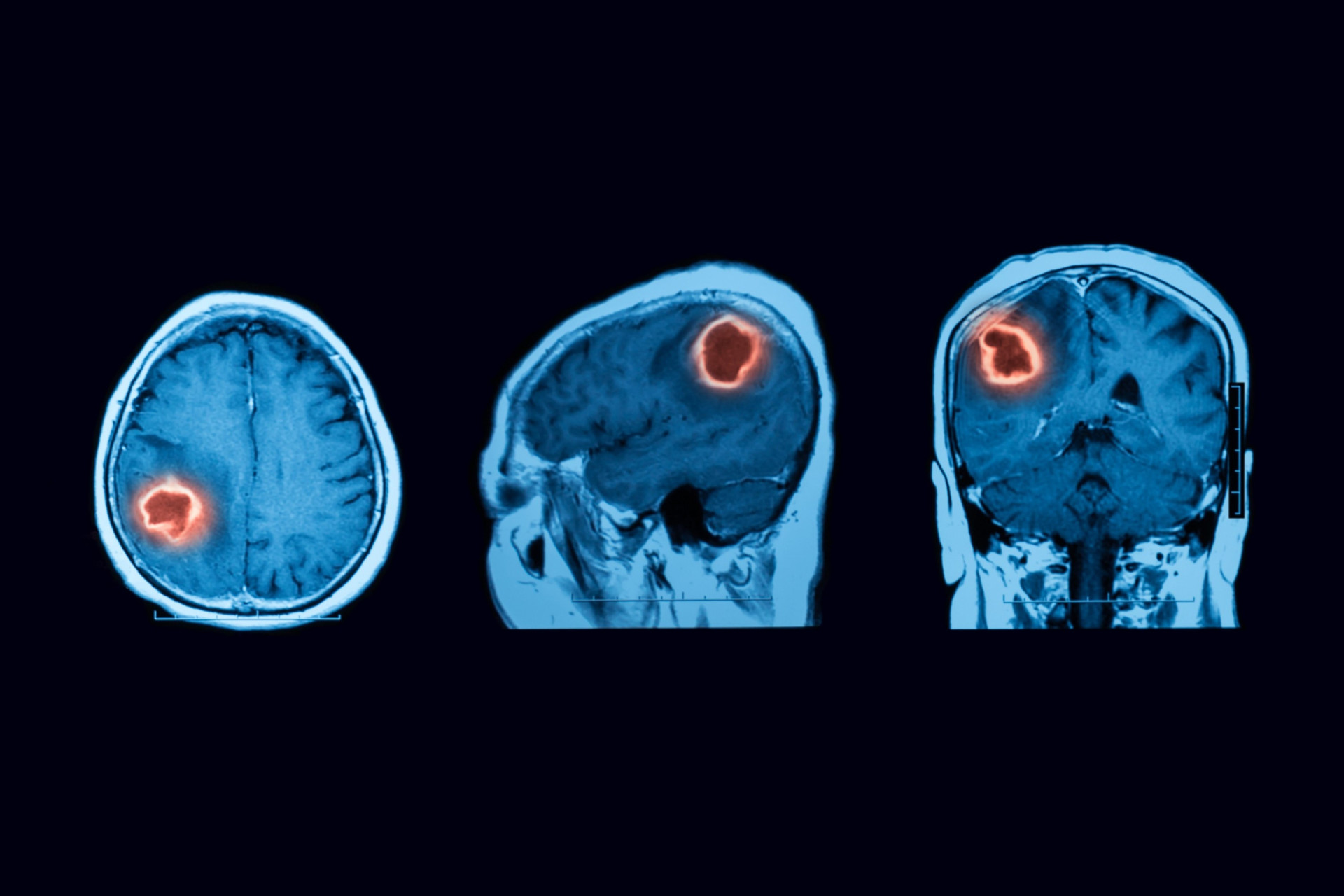 What are the most dangerous types of brain bleeds?
