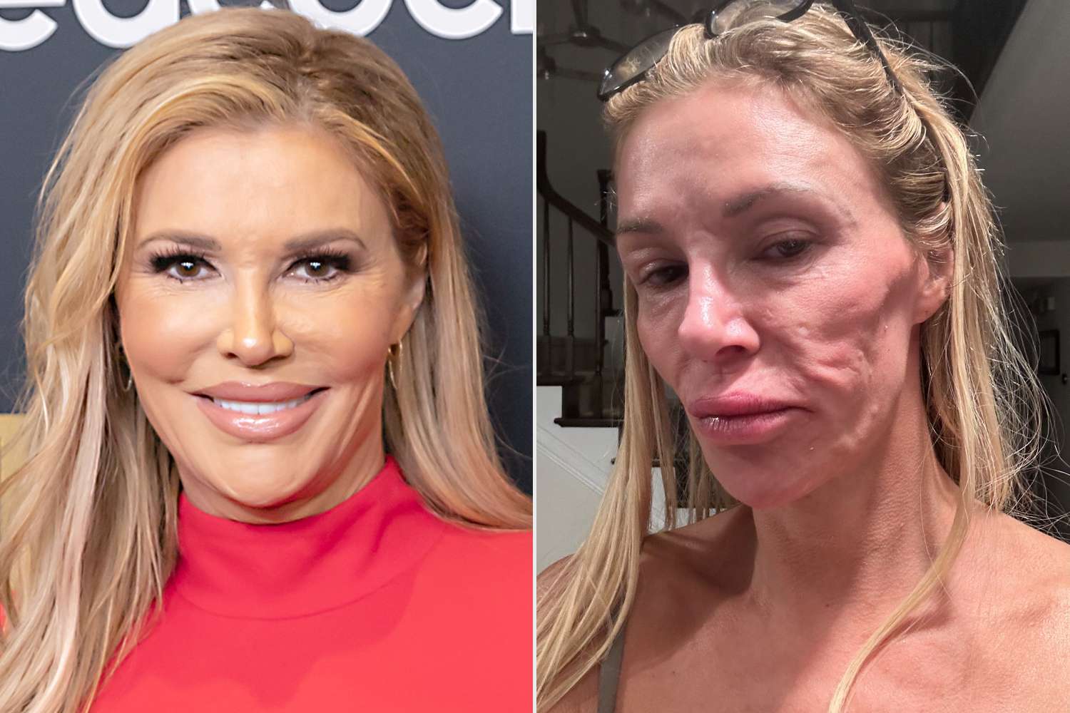 Brandi Glanville Shares Update on Biopsy Results for Facial ‘Parasite ...