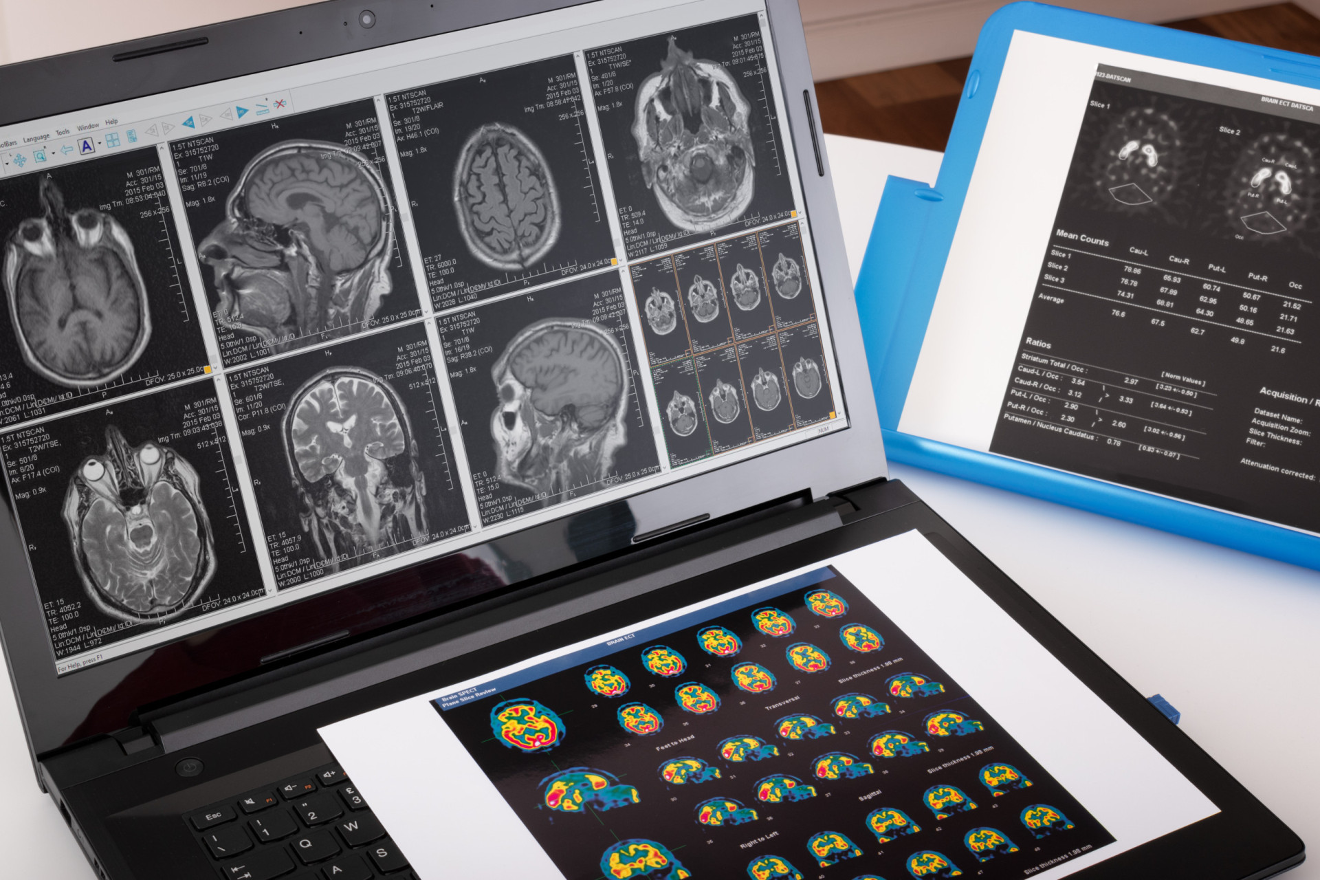 Alice in Wonderland syndrome: a neurological condition