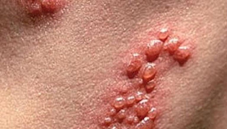 Herpes genital: síntomas, causas, diagnóstico y tratamiento completo