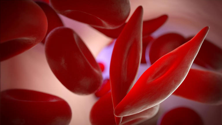 Anemia falciforme: síntomas, causas y nuevos tratamientos