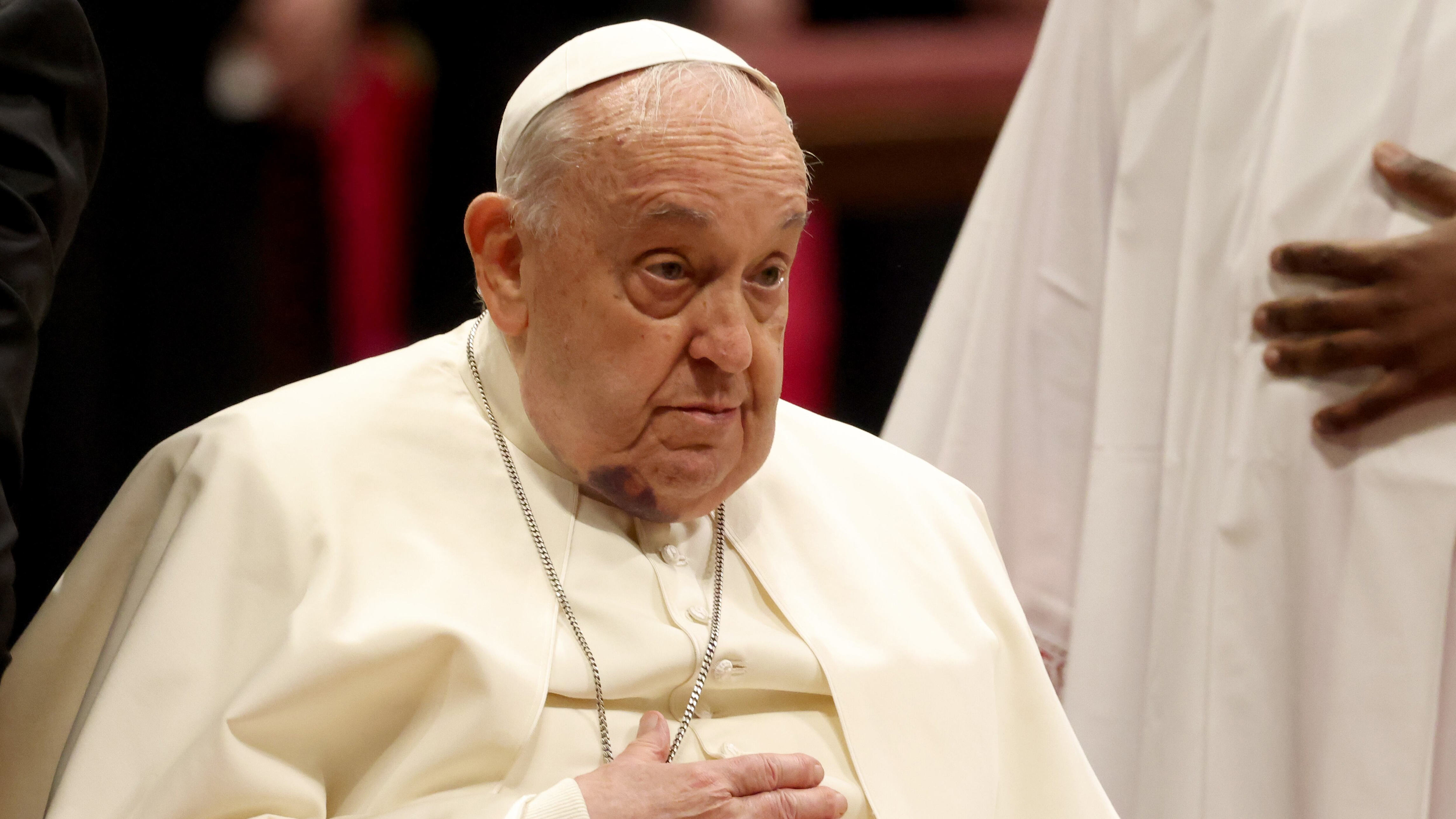 Pope Francis Sparks Health Concerns With Mystery Bruise Pope Francis Sparks Health Concerns With Mystery Bruise