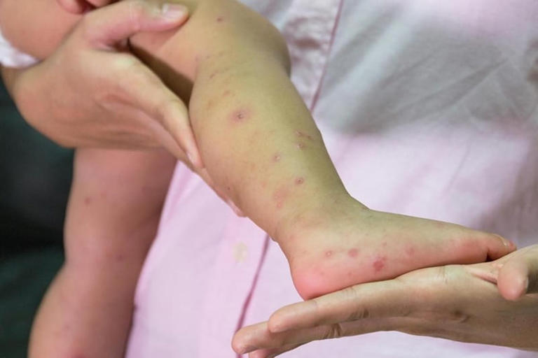 Epidémie de Bouhamroun : Un taux de vaccination en baisse et un ...