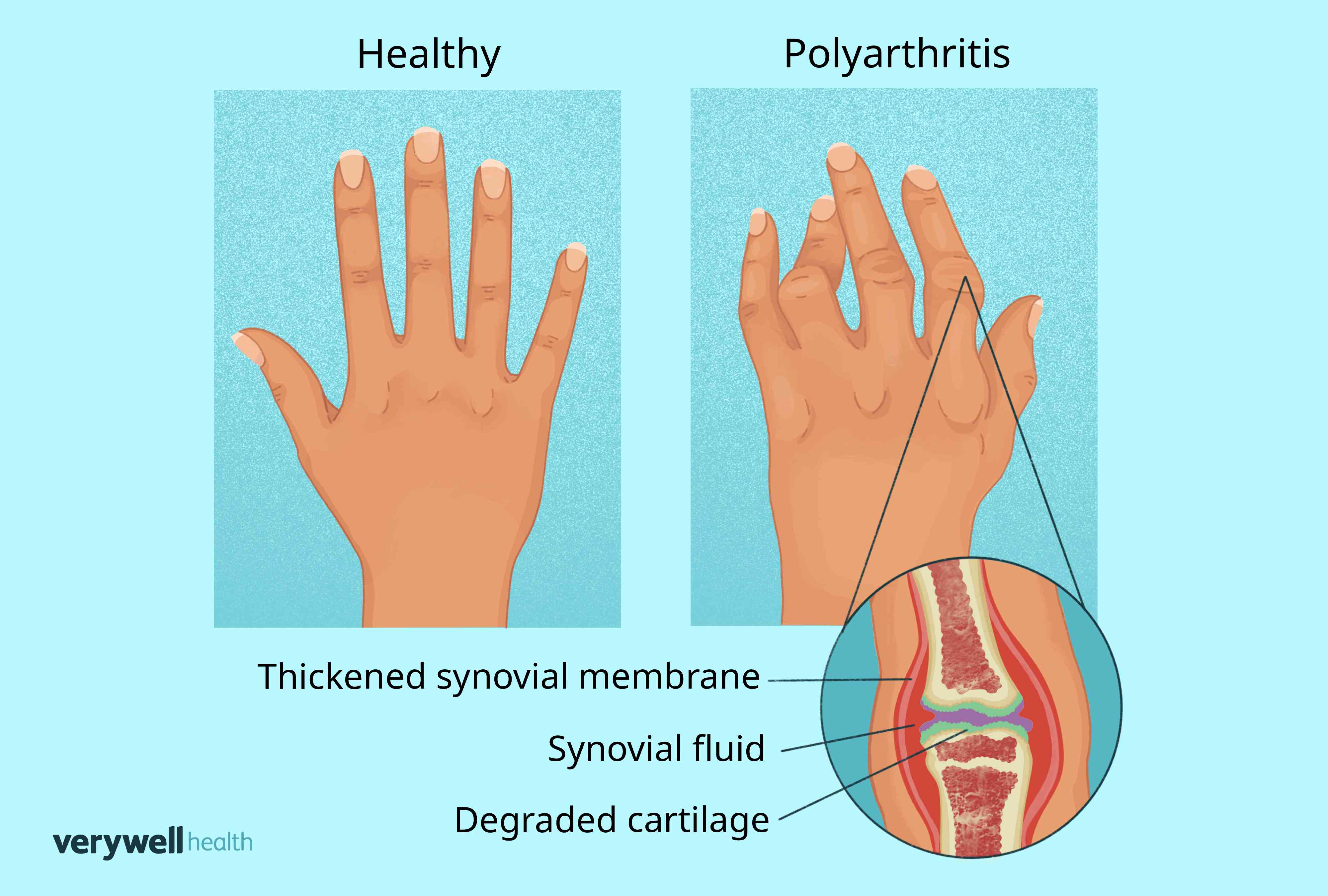 What to Know About Inflammatory Polyarthritis