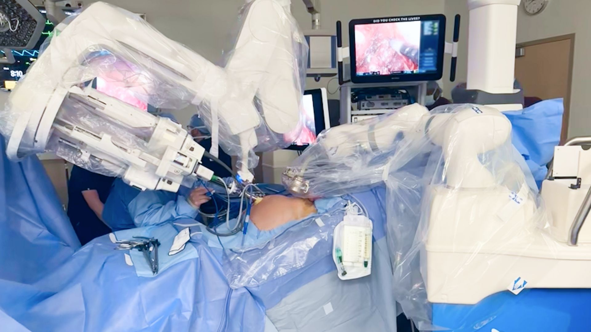 First-ever dual-robot surgery removes prostate gland, advances ...