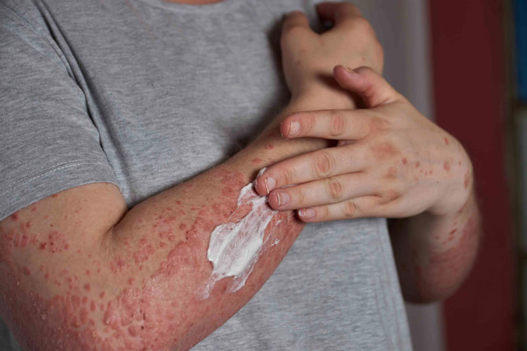 How to properly moisturize and treat psoriasis