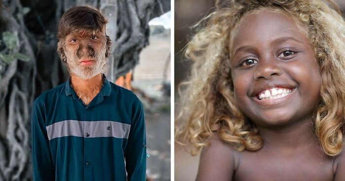 47 Times Human Genetics Led To Some Unique Body Characteristics
