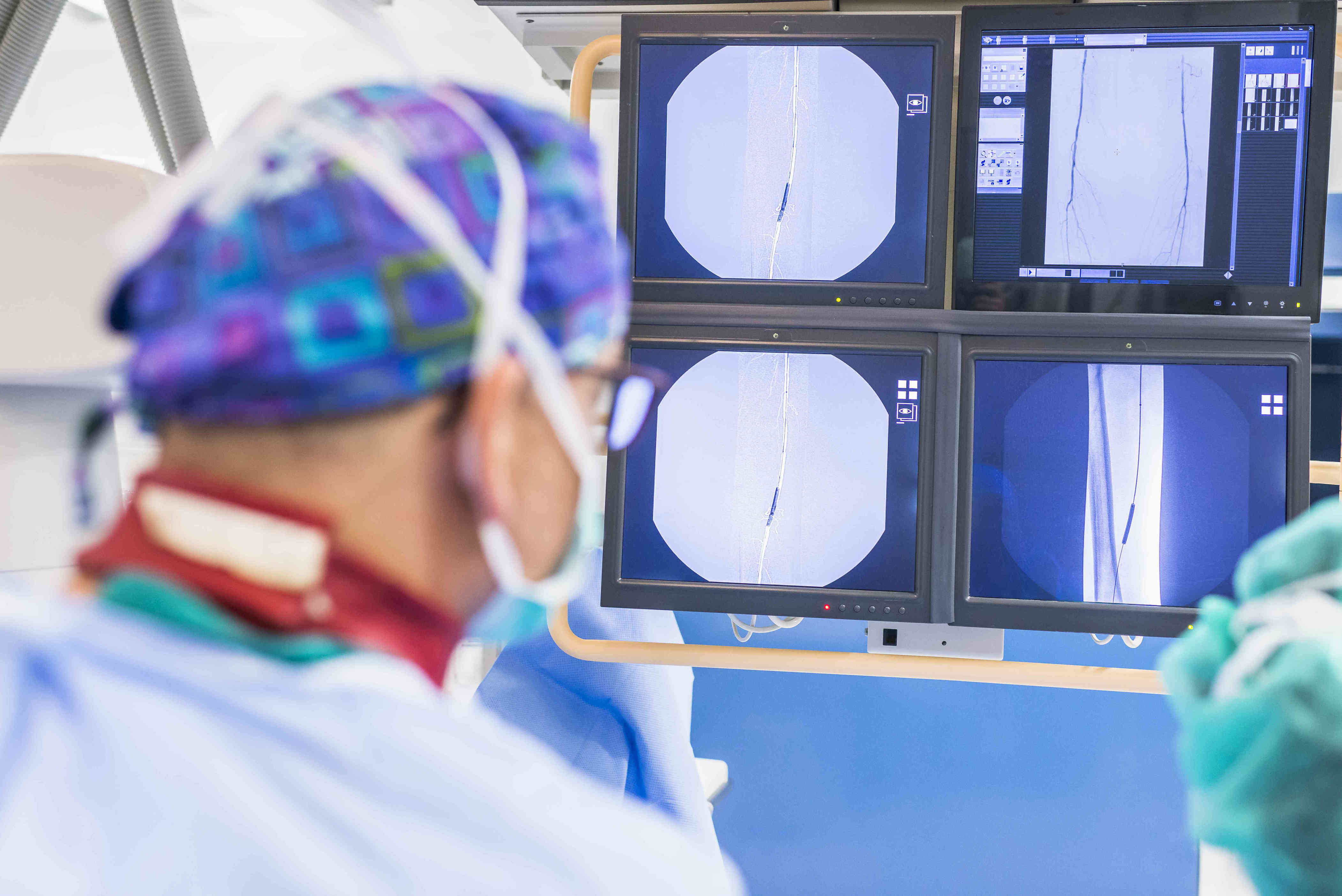 What To Know About Nerve Ablation (Radiofrequency Ablation)