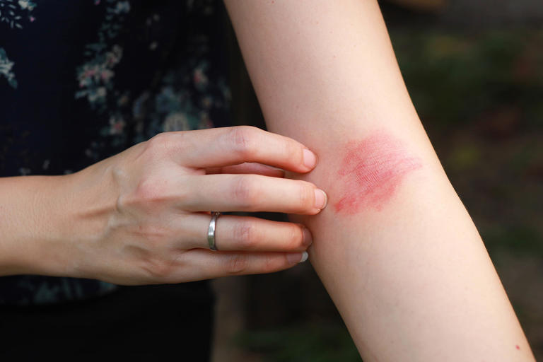 Eczema pictures and dermatologist tips to identify your itchy, red rash