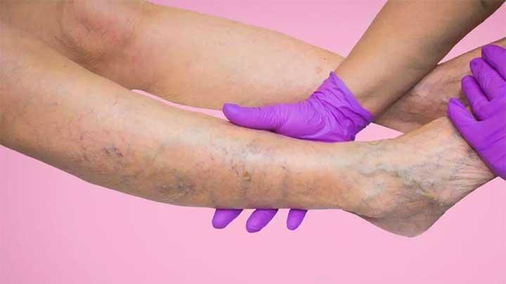 Penyebab, Gejala, dan Perawatan Varises Kaki