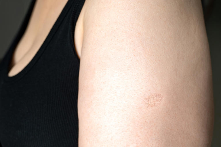 Why You Have a Smallpox Vaccine Scar and What it Means