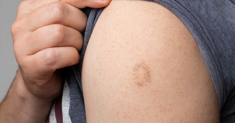 Why You Have a Smallpox Vaccine Scar and What it Means
