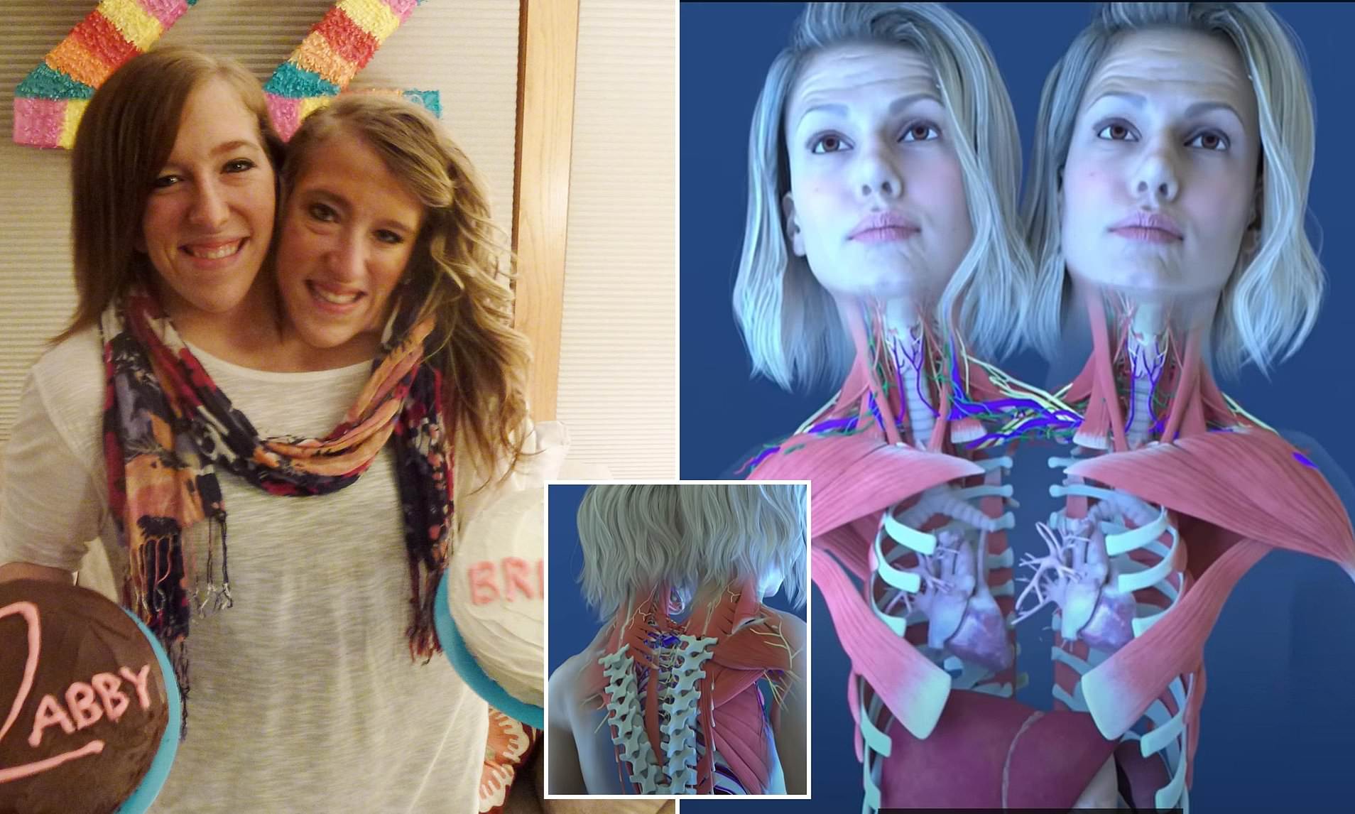 Conjoined twins Abby and Brittany reveal how they are conjoined