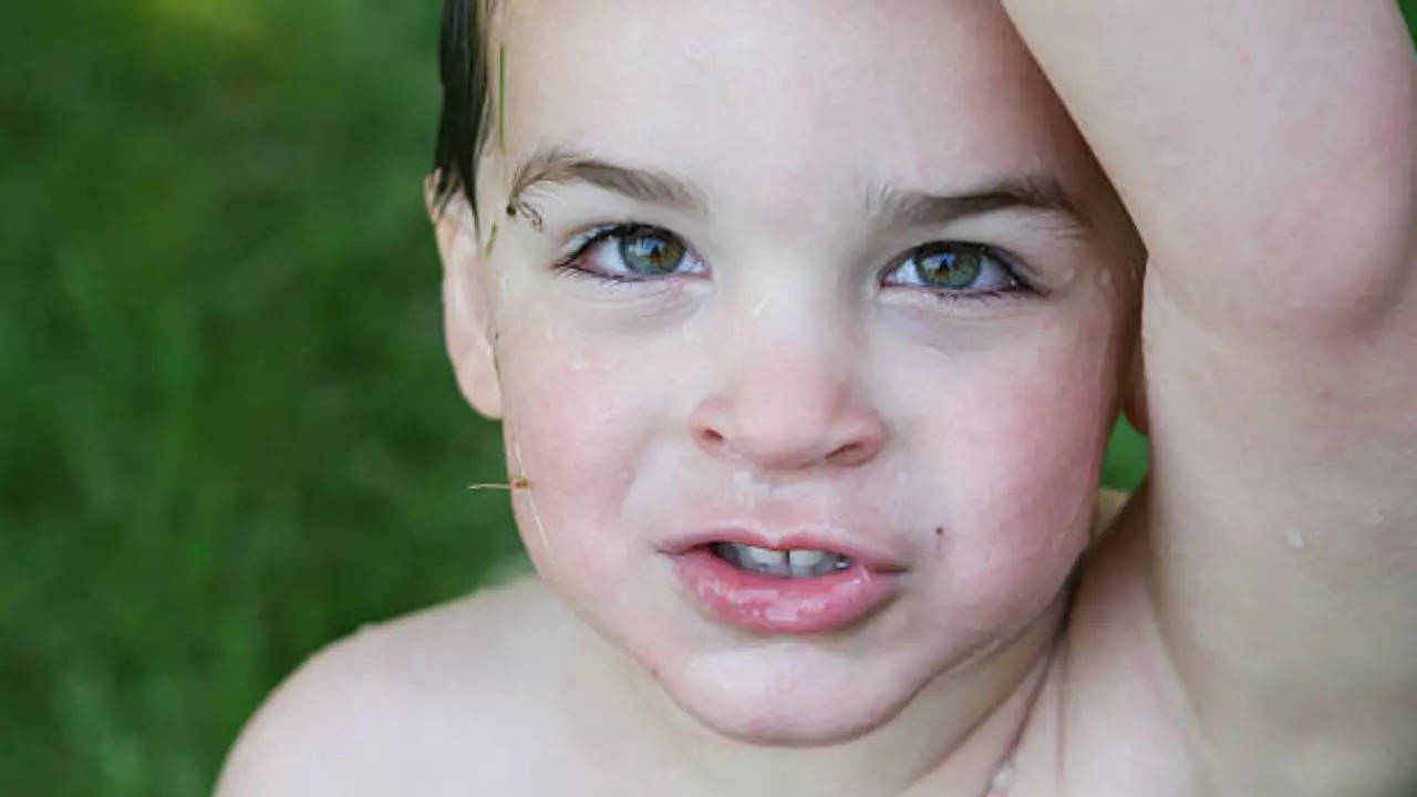 What Is Slapped Cheek Syndrome US CDC Has Issued Warning For?