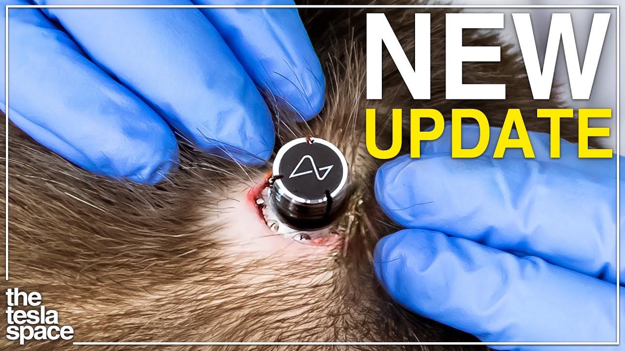 Neuralink Reveals Major NEW Human Trial Update