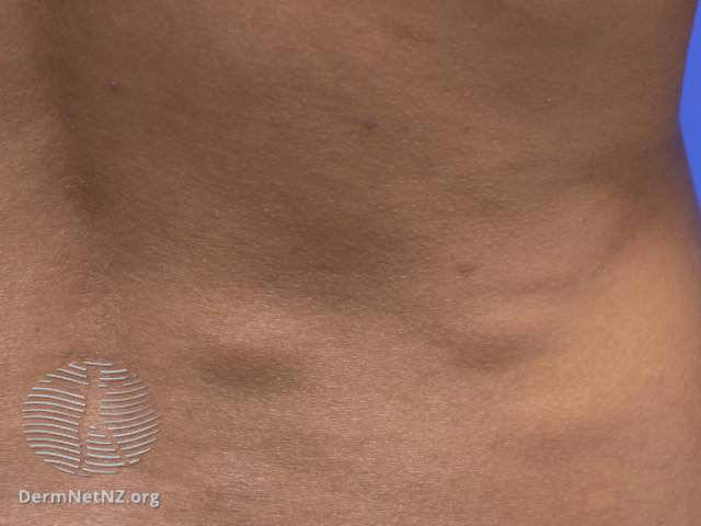 What you need to know about back mice (including the best treatment)