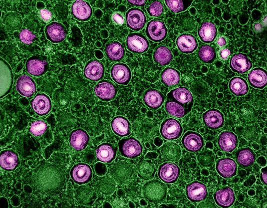 New Study Finds Link Between Common Childhood Virus And Alzheimer's Disease New Study Finds Link Between Common Childhood Virus And Alzheimer's Disease