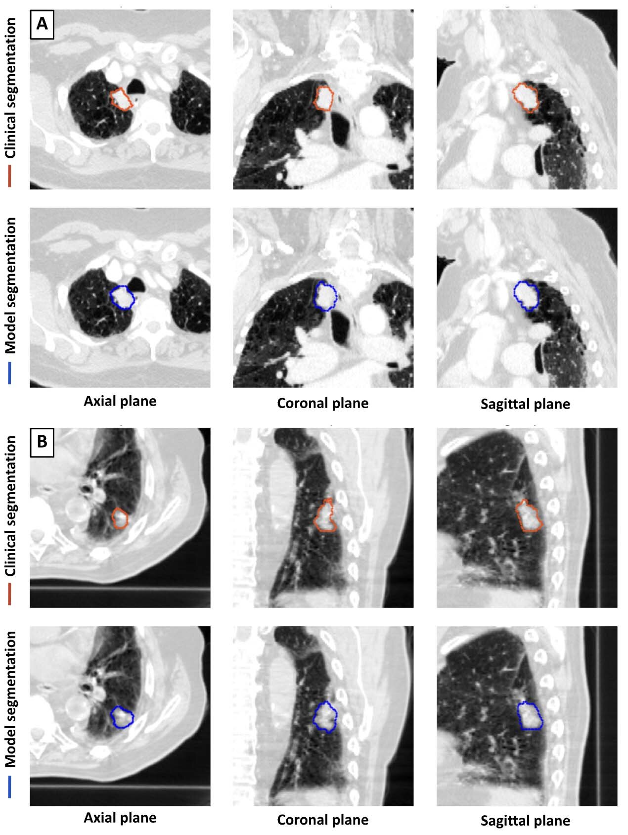 Deep learning model helps detect lung tumors on CT scans