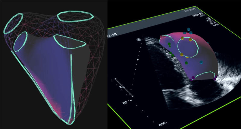 Ventripoint refines AI-powered heart scanner submission to FDA
