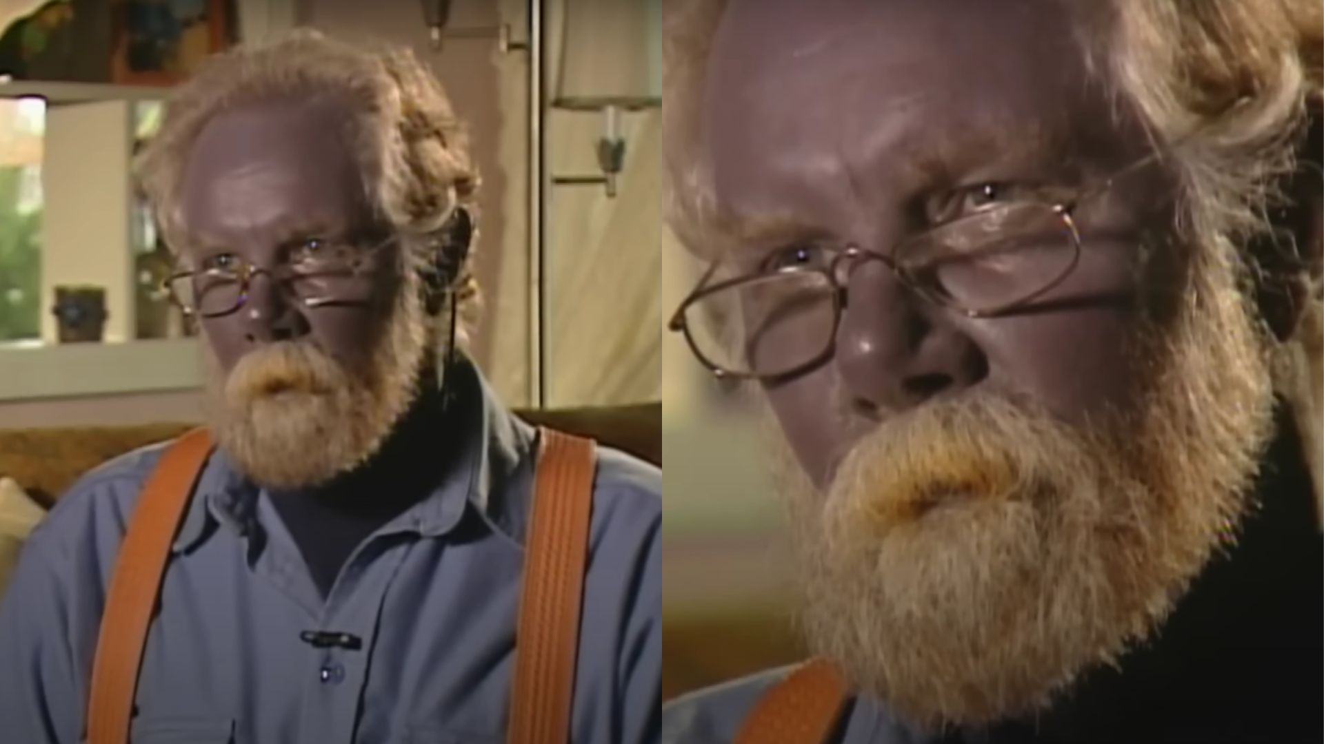 Homem desenvolve condição rara que deixa sua pele azul