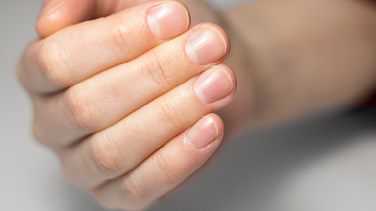 Ridges in nails can denote these 5 health risks