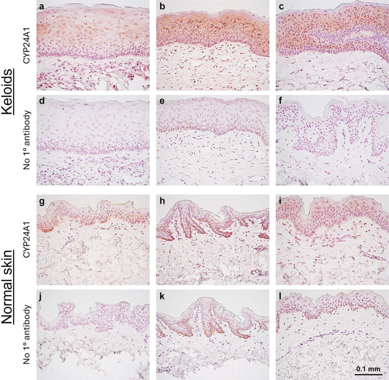 Vitamin D and keloid scars: Researchers find inhibiting enzyme could ...