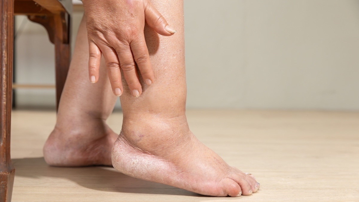 My Legs Felt Like Tree Trunks-How I Finally Found Lipedema Treatment ...