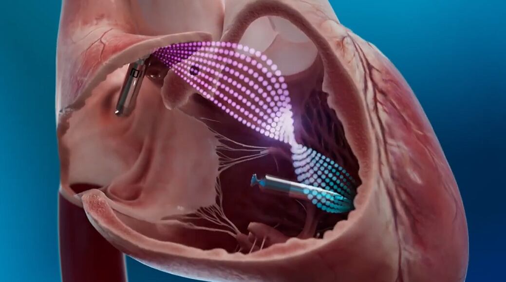 The new “no surgery, no wires” pacemaker