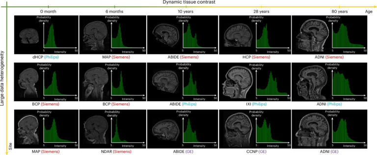 How artificial intelligence can make MRI more accurate and reliable
