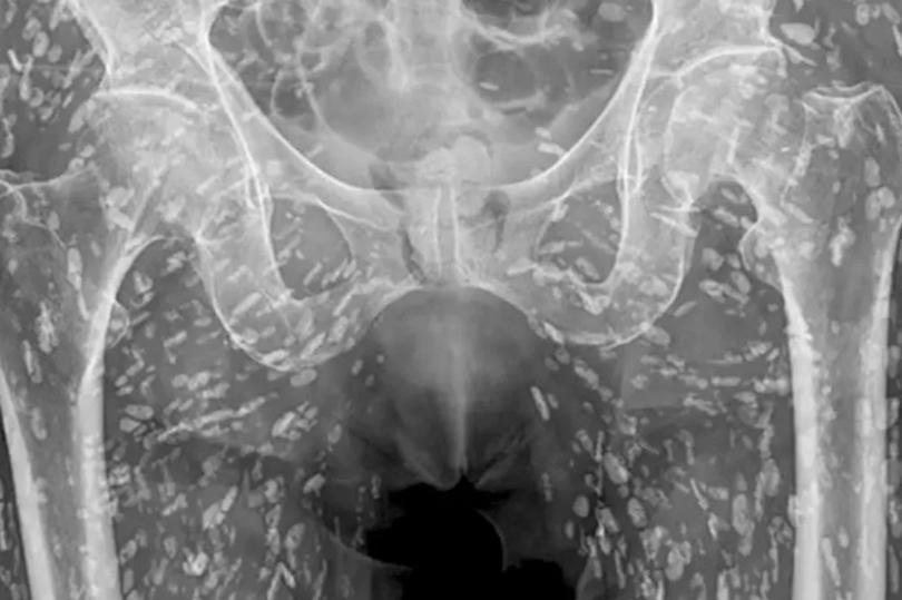 Disgusting x-ray shows shocking 'zombie' tapeworm infection following ...