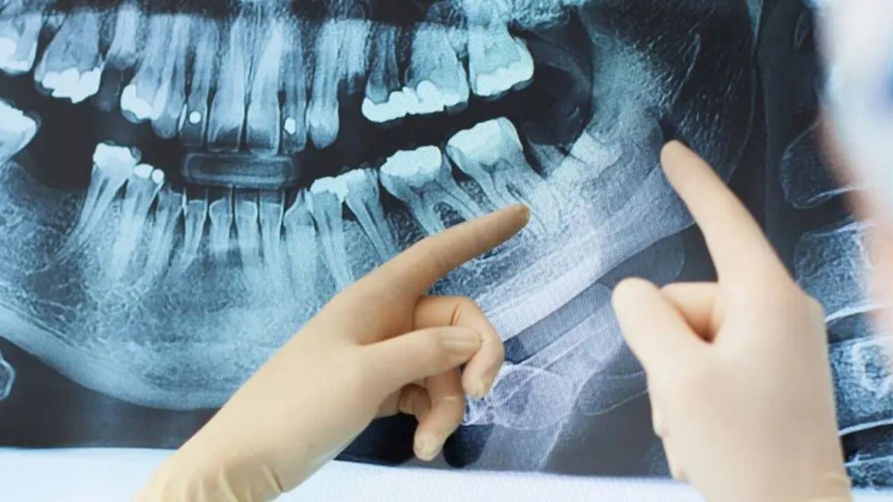 Do Dental X-Rays Cause Cancer?