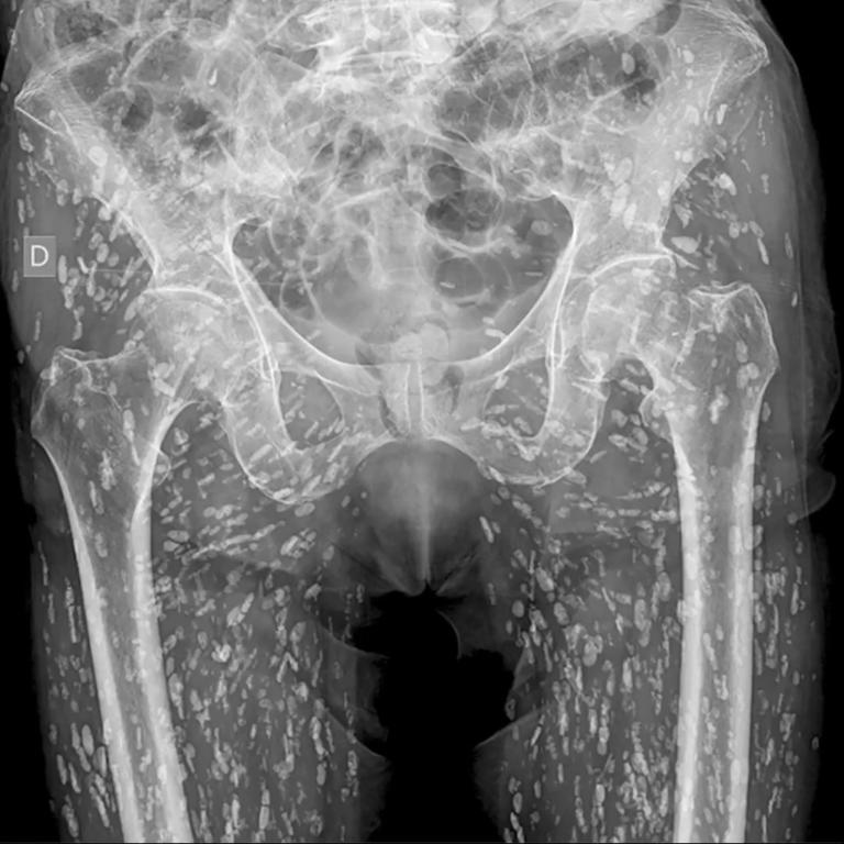 ‘Insane X-ray’ shows body filled with tapeworm larvae — ER doc reveals ...