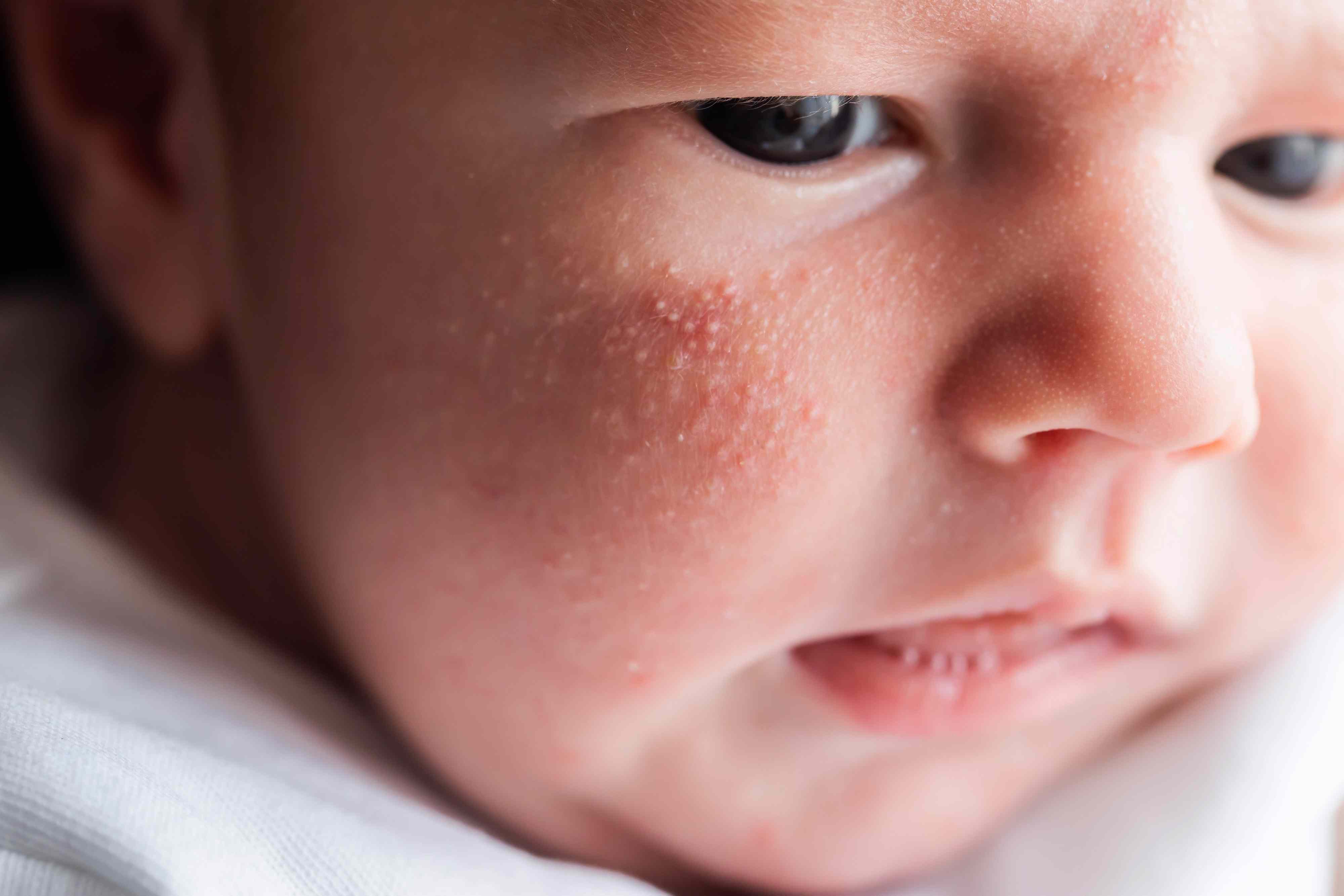 How to Spot Baby Acne and What to Do Next