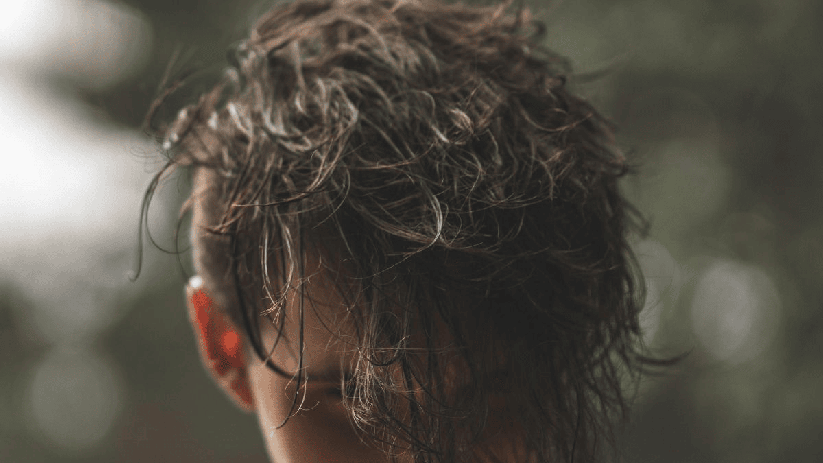 How to Get Rid of Dandruff with Treatments and Home Remedies