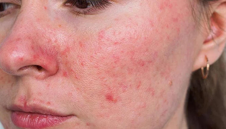 5 DIY Ways To Use Volcanic Ash Clay for Skin