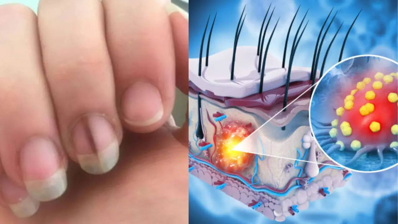 Woman's Unusual Nail Was The First Sign of Stage 4 Terminal Cancer ...