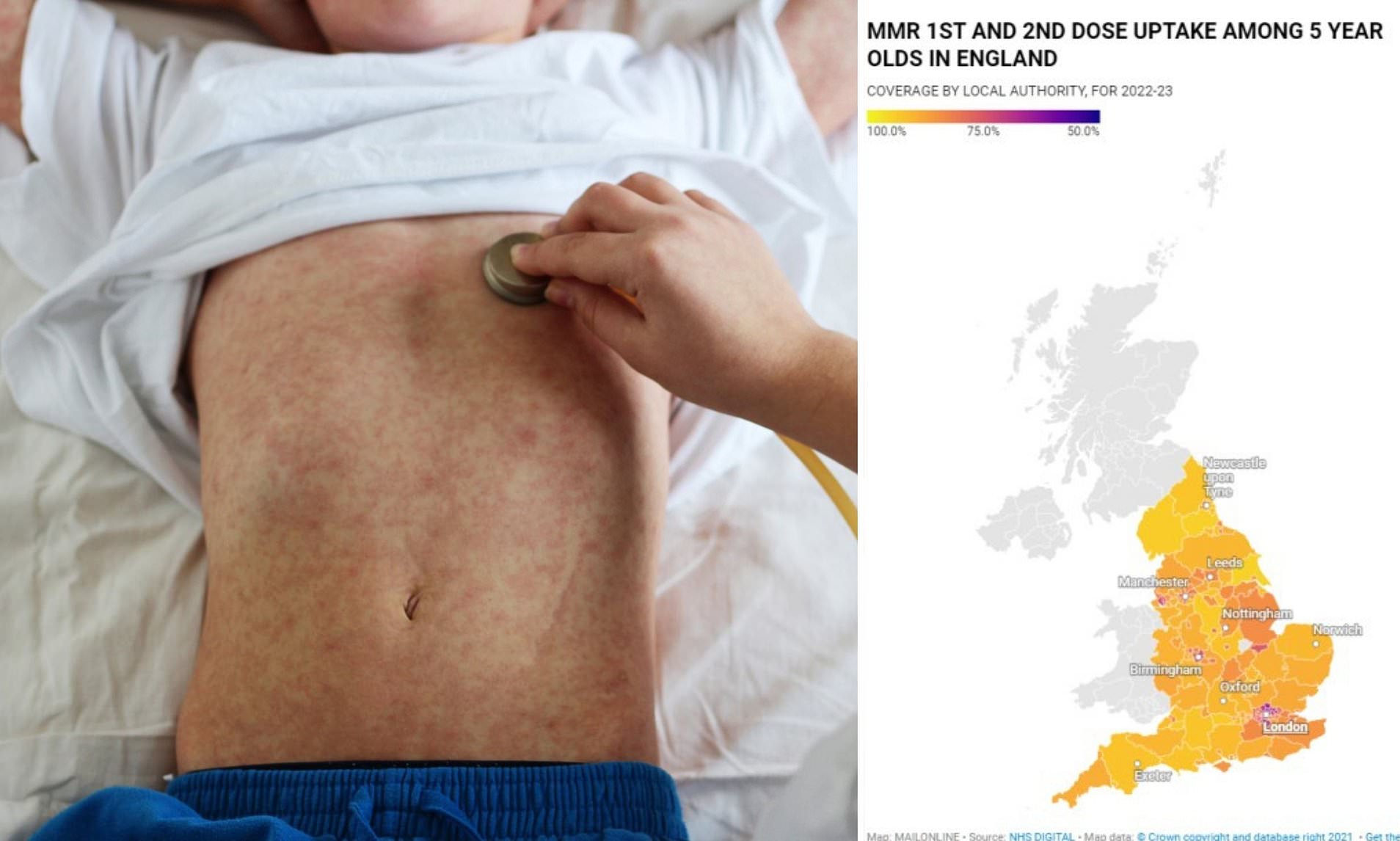 Health chiefs warn of 'rapid rise' in deadly measles in parts of UK